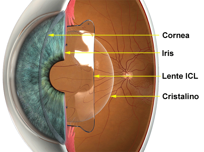 Implante ICL (Lente de Contacto Intraocular) – OFTALSUR